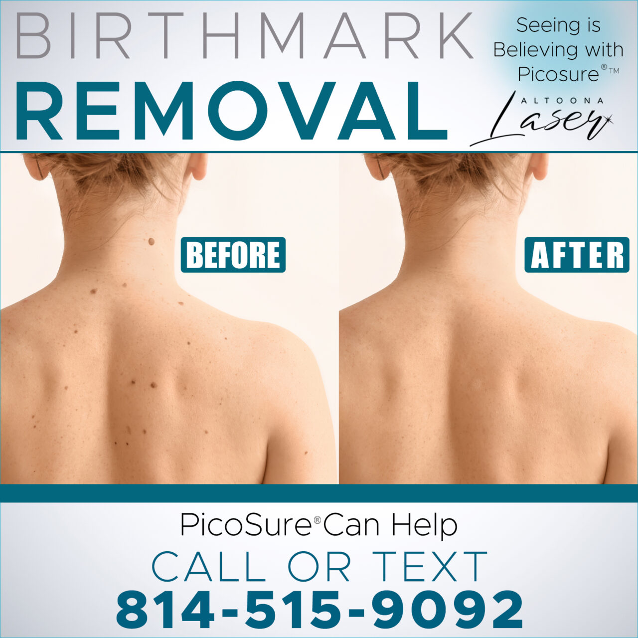 Birthmark Laser Removal - Call or text Altoona Laser at (814) 515-9092